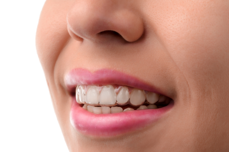 How Much Is Invisalign Monthly? | Central Texas Orthodontics