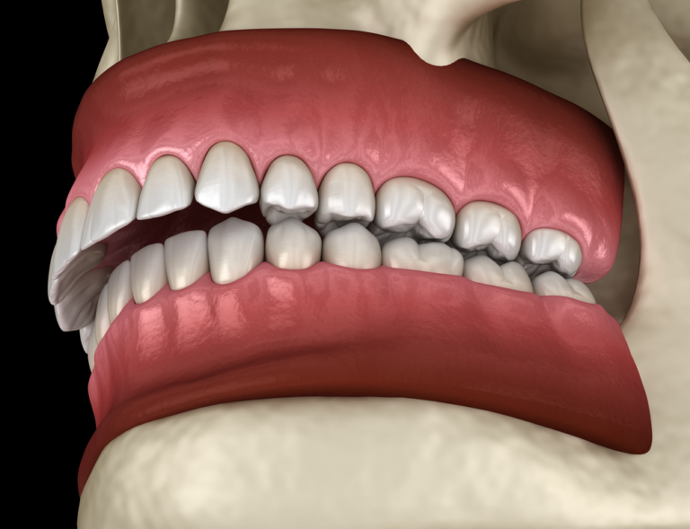 How Do You Correct an Overbite? - Central Texas Orthodontics